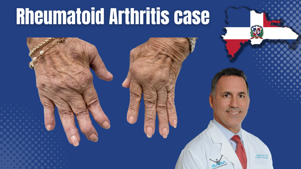 What Causes Hand Deformities in Rheumatoid Arthritis? - DrBadia.com