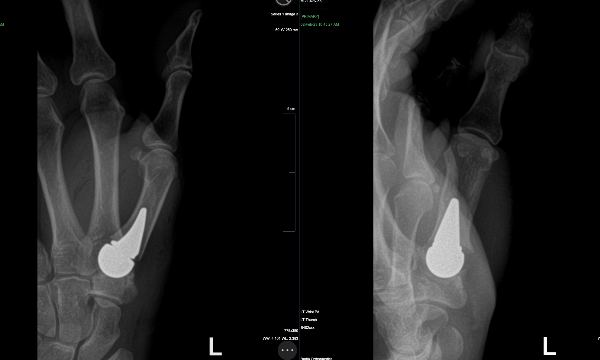Technologies for osteoarthritis of the thumb - DrBadia.com