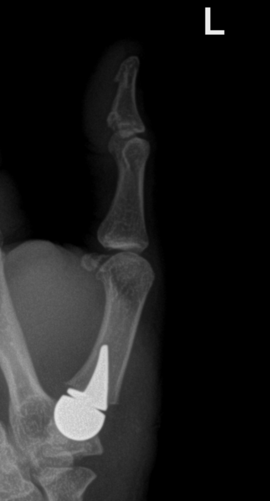 Basal Joint Arthritis - DrBadia.com