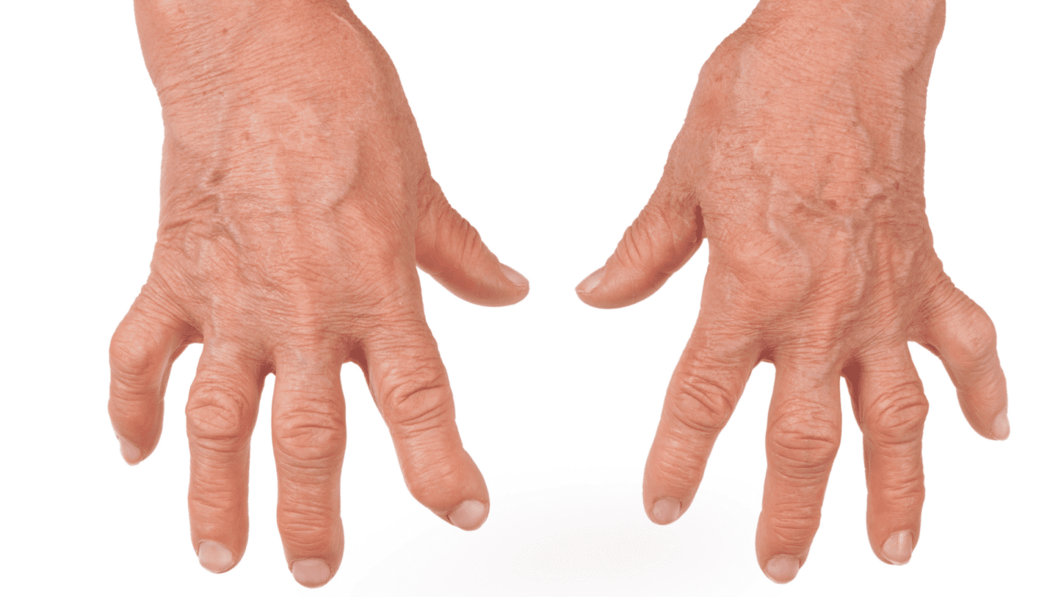 Types of hand deformities caused by RA - Badia Hand to Shoulder Center