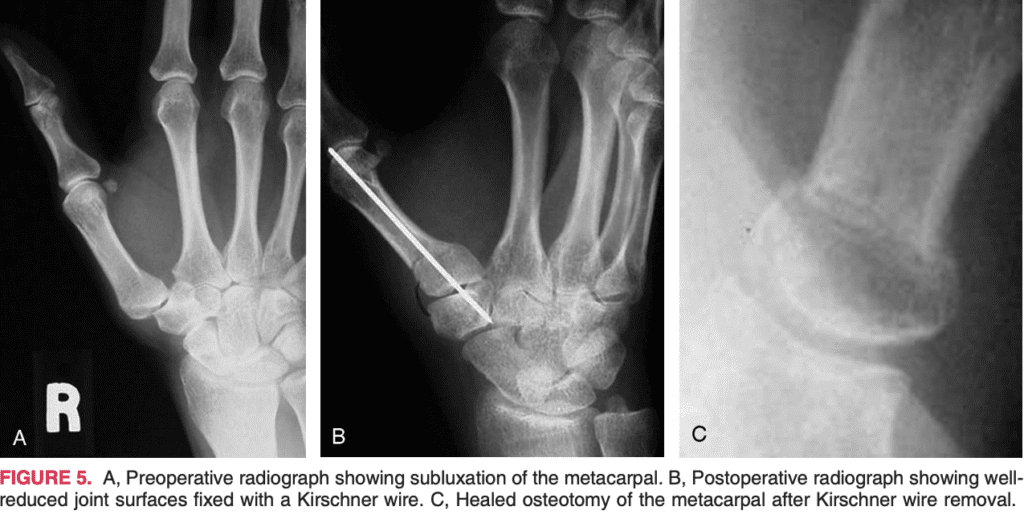 Treatment of Early Basal Joint Arthritis - DrBadia.com