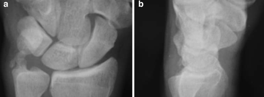Tears of the Scapholunate & Lunotriquetral Ligaments - DrBadia.com