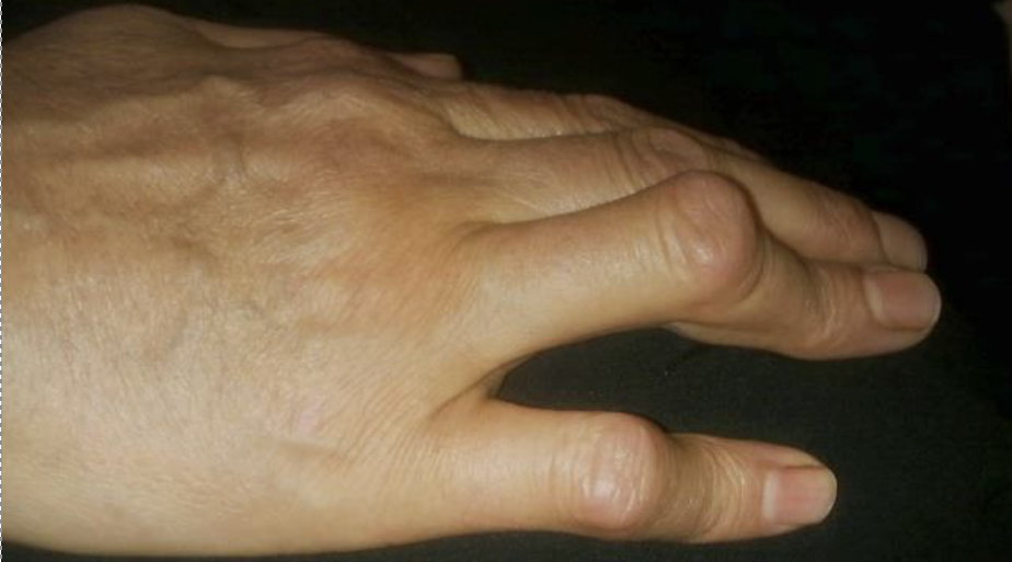 Types of hand deformities caused by RA - Badia Hand to Shoulder Center