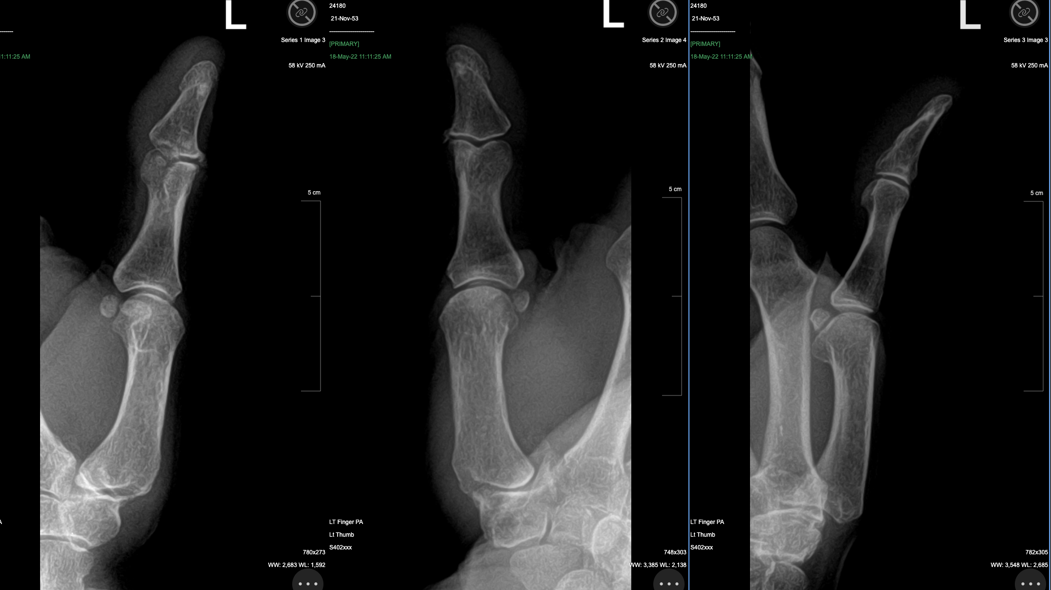 Thumb Joint Replacement- Step By Step - DrBadia.com
